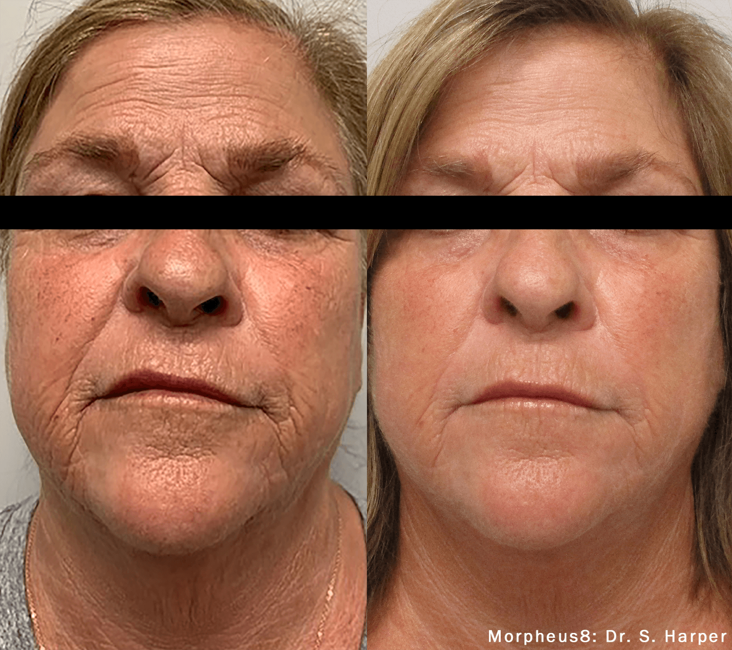 Hyperpigmentation Before & After Photos | Imperial Dermatology